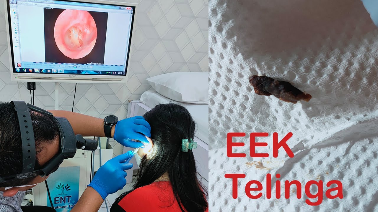 SEDOT KUPING KOTOR PENYEBAB TELINGA BERDENGING! EEK NYA GEDE HITAM PULA ...