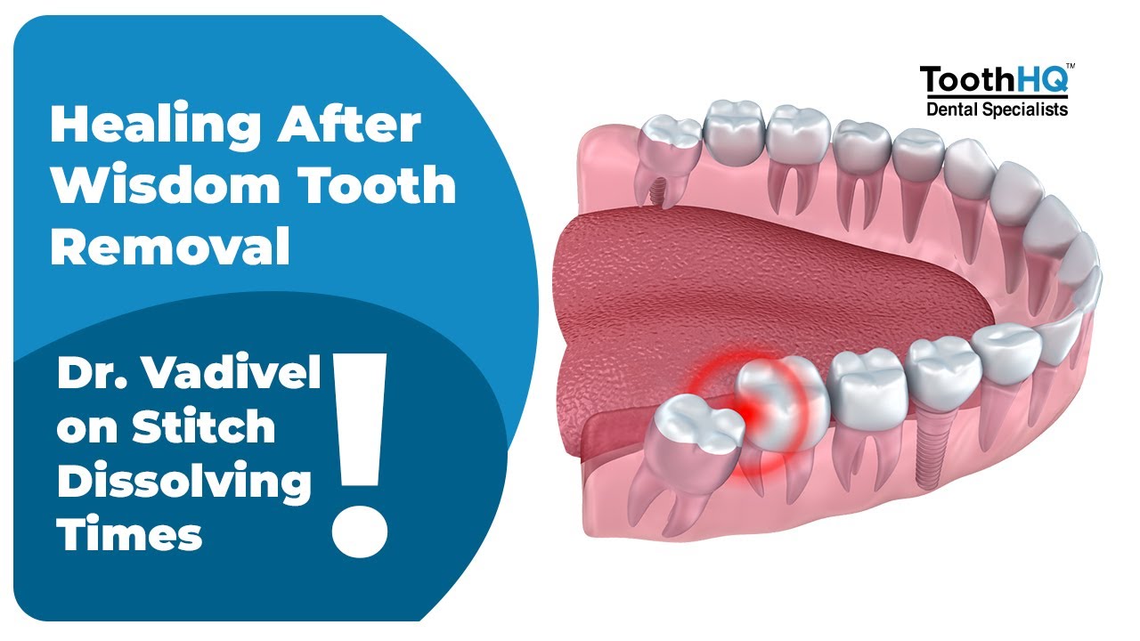 Healing After Wisdom Tooth Removal: Dr. Vadivel on Stitch Dissolving ...