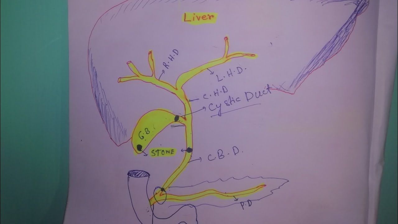 MRI MRCP Gall bladder stone all about biliary tree | - YouTube