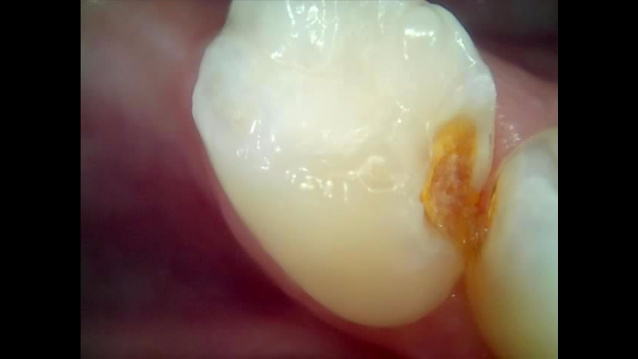 [20] Dental restoration of pediatric tooth decay - YouTube