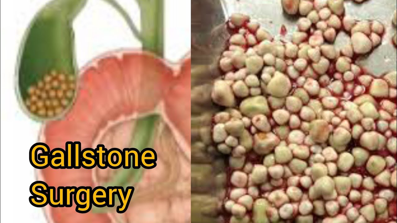 Laproscopic cholecystectomy - cholecystitis - gallstone surgery ...