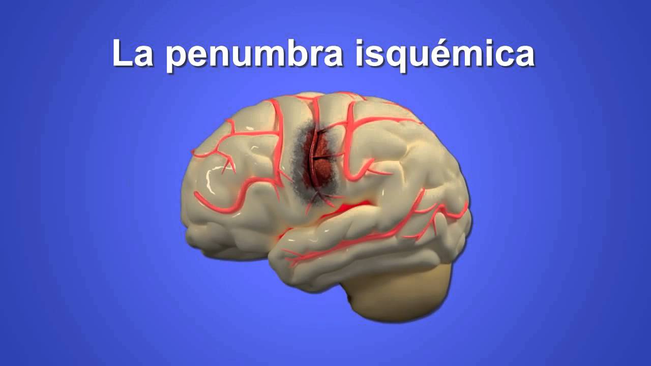 Qué es un Ictus - YouTube