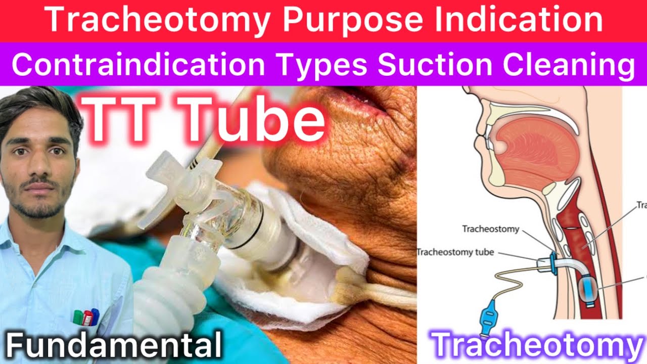 Tracheotomy Purpose Indication Contraindication Type Suction Cleaning ...