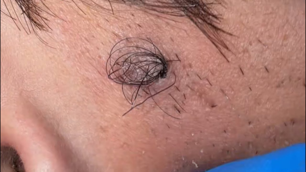 The largest amount of hair gathered under the skin, watch how to ...