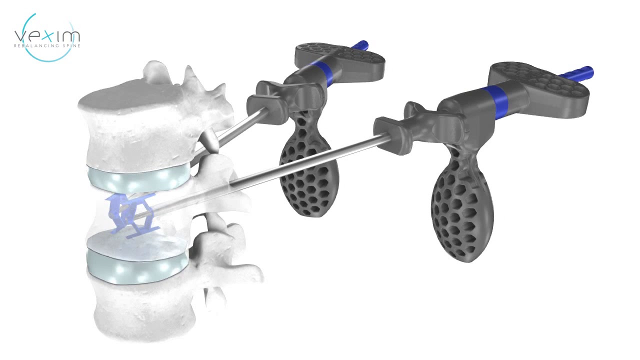 Spinejack - Animated Technique - YouTube