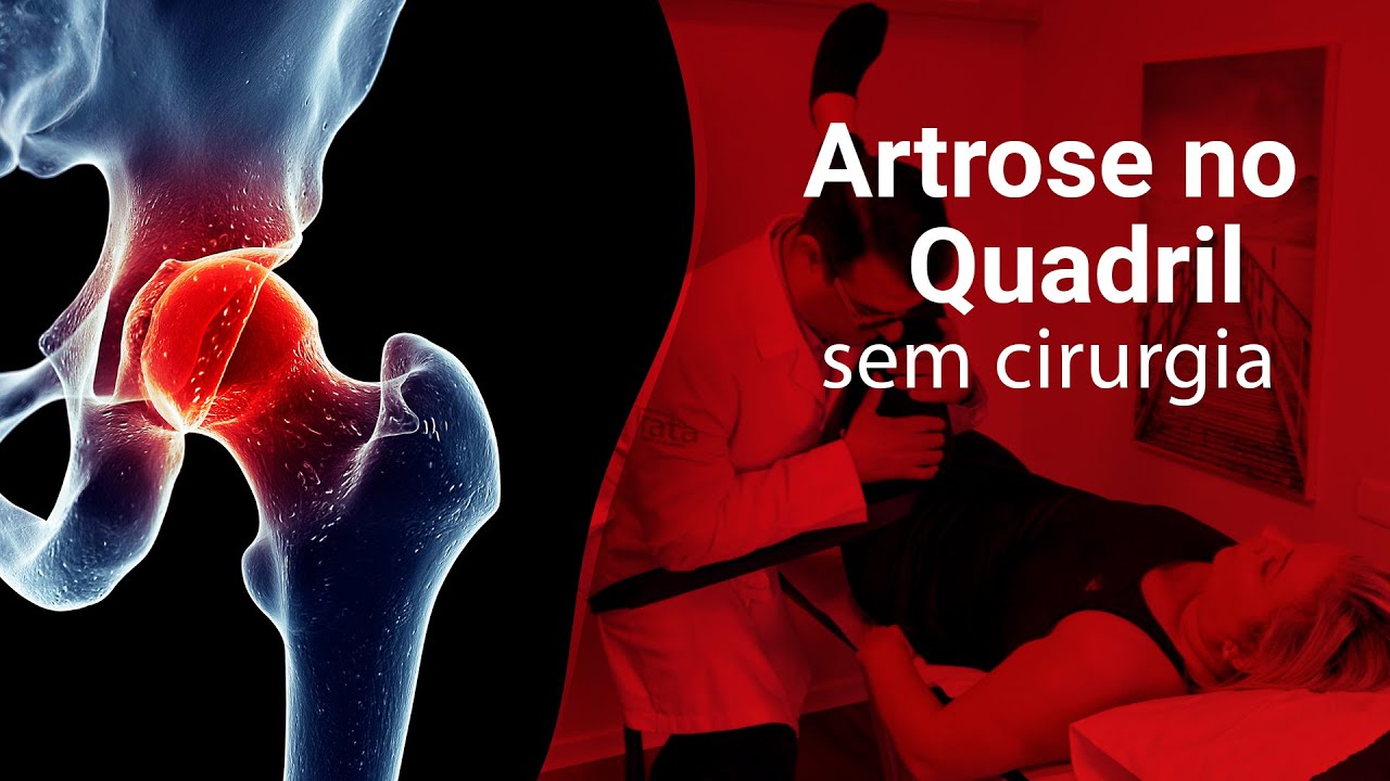 Artrose no Quadril Sem Cirurgia - Conheça o Tratamento - YouTube