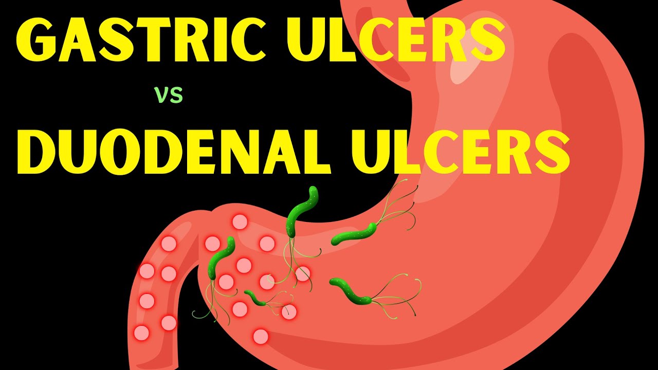 How to differentiate Gastric ulcers from Duodenal ulcers? - YouTube