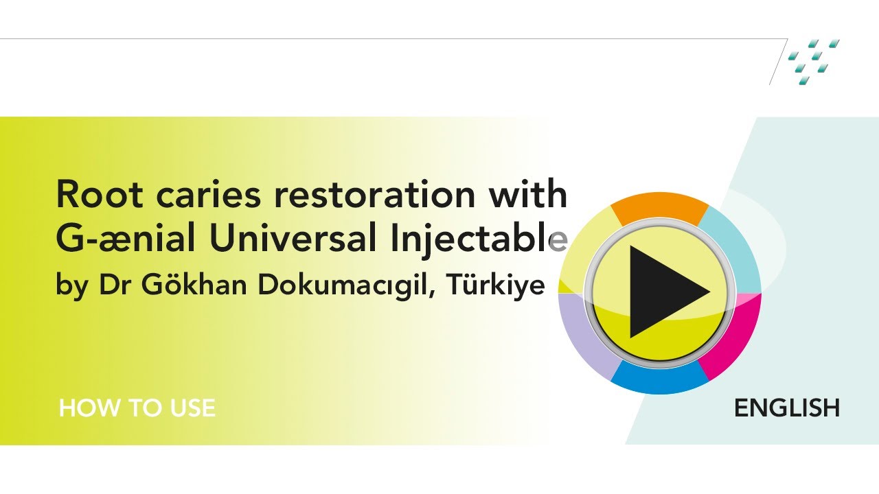 Root caries restoration with G aenial Universal Injectable by Dr Gökhan ...