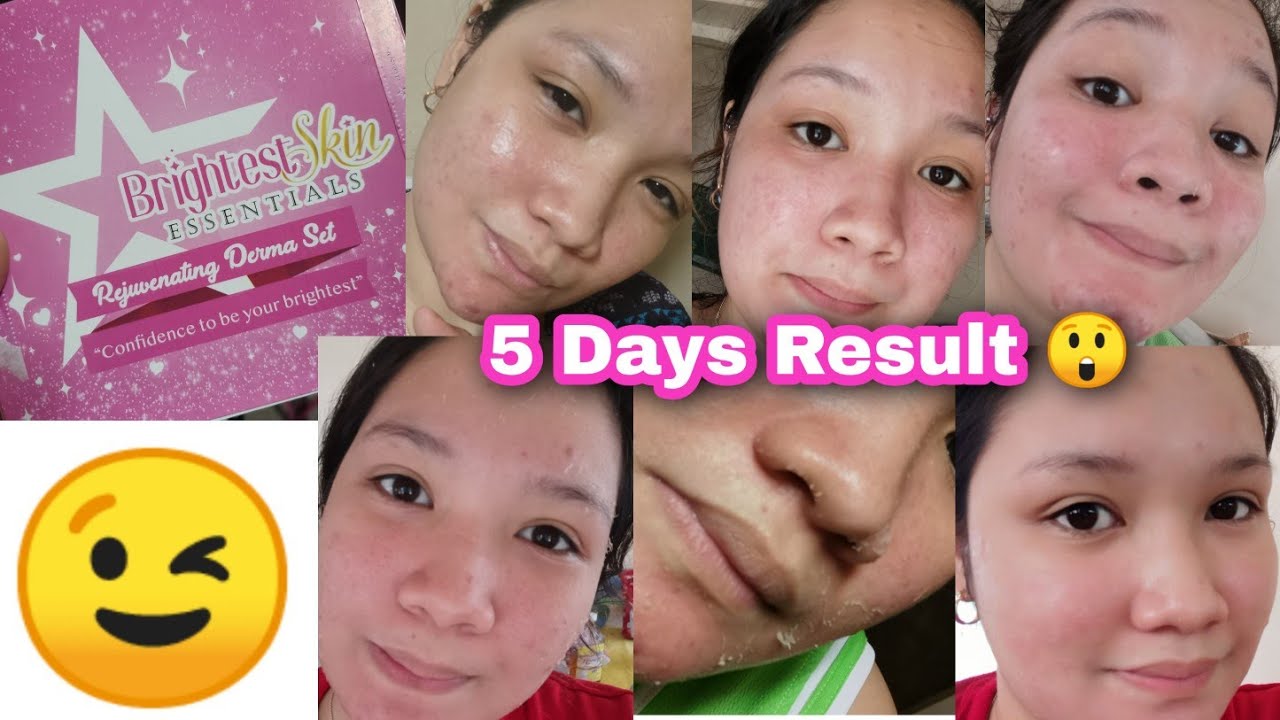 5 DAYS RESULT OF USING BRIGHTEST SKIN ESSENTIALS - YouTube
