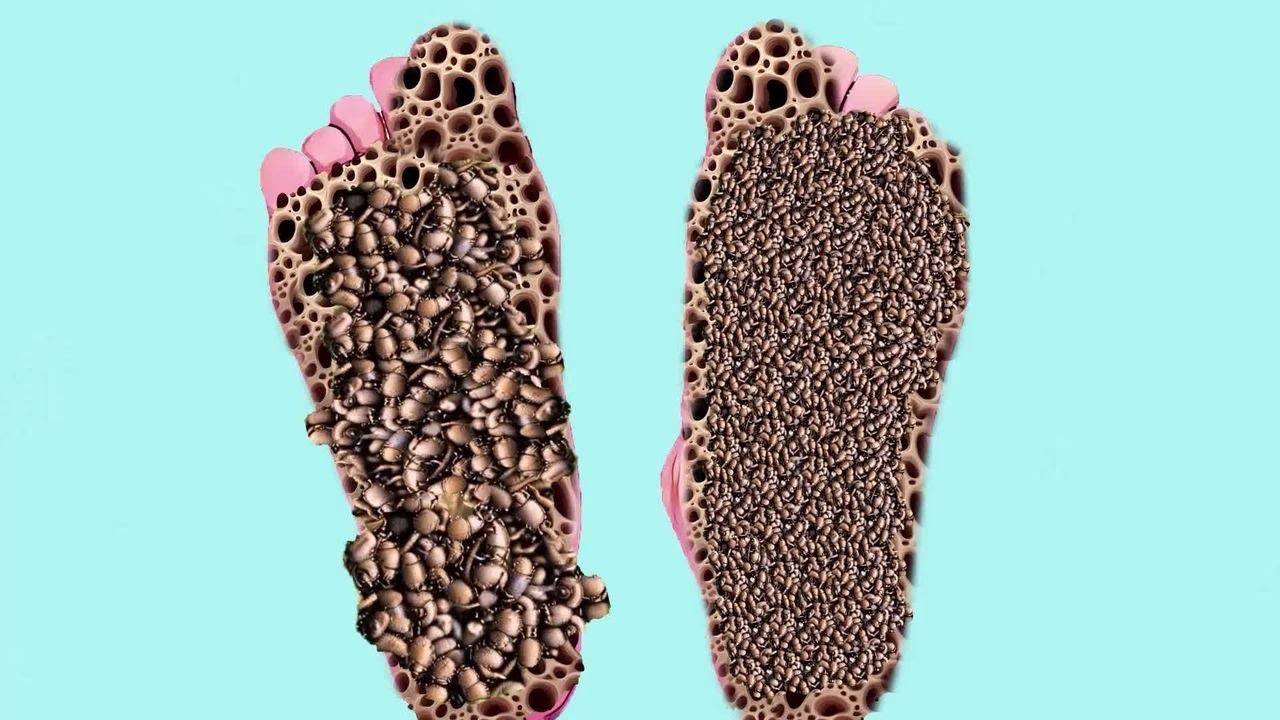 ASMR ANIMATION FOOT SOLE MAGGOTS REMOVAL TREATMENT - YouTube