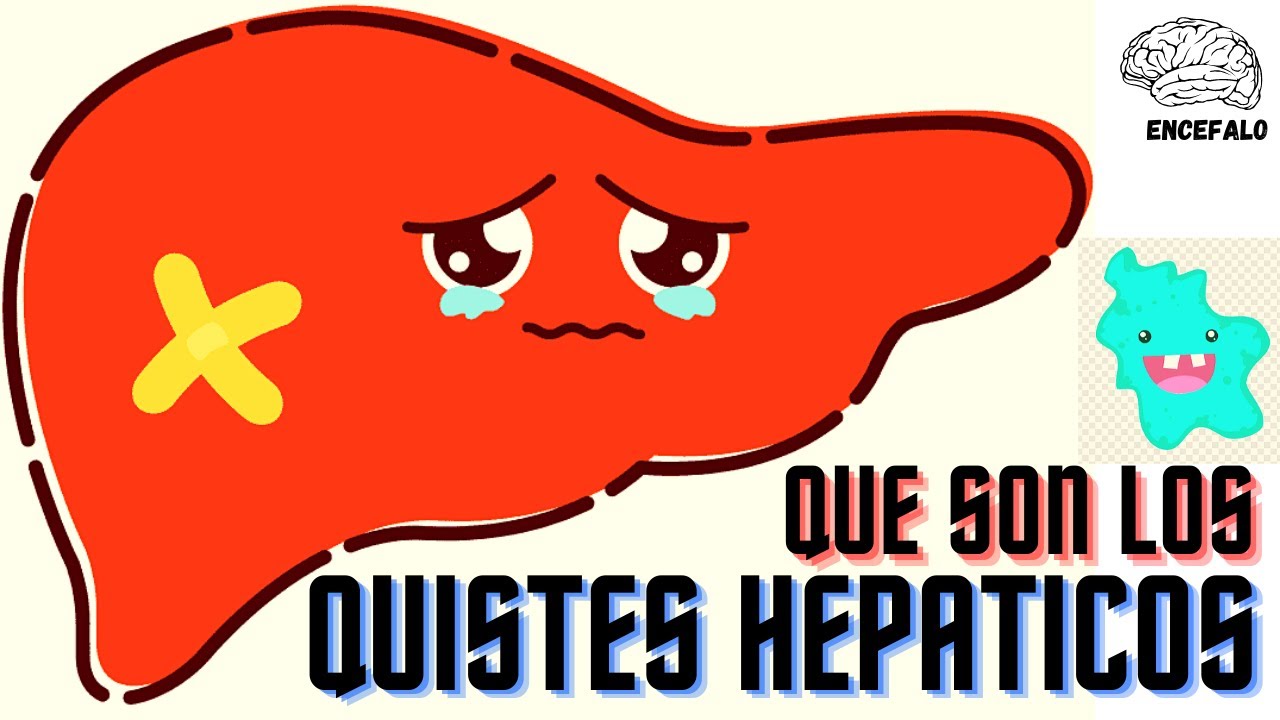 💖 QUISTE HEPATICO 💖 ¿Que son los quistes hepáticos, Causas, Síntomas y ...
