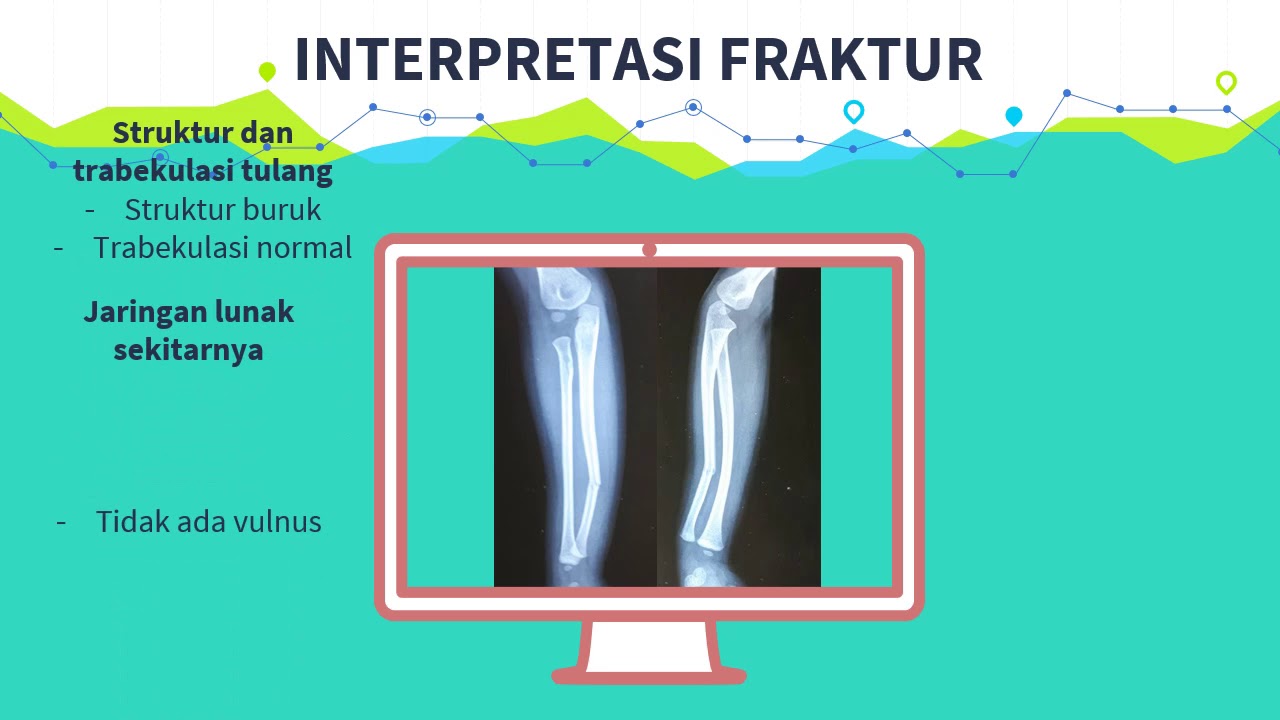Interpretasi Foto Rontgen Fraktur Ulna Media - FK UII - YouTube