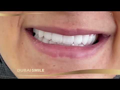 Hollywood Smile price in UAE