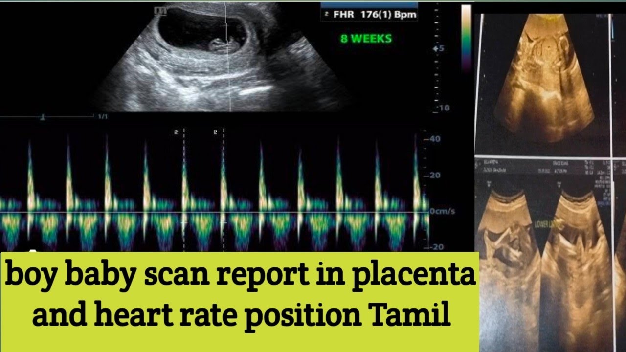 Boy baby scan report placenta heart rate position in gender prediction ...