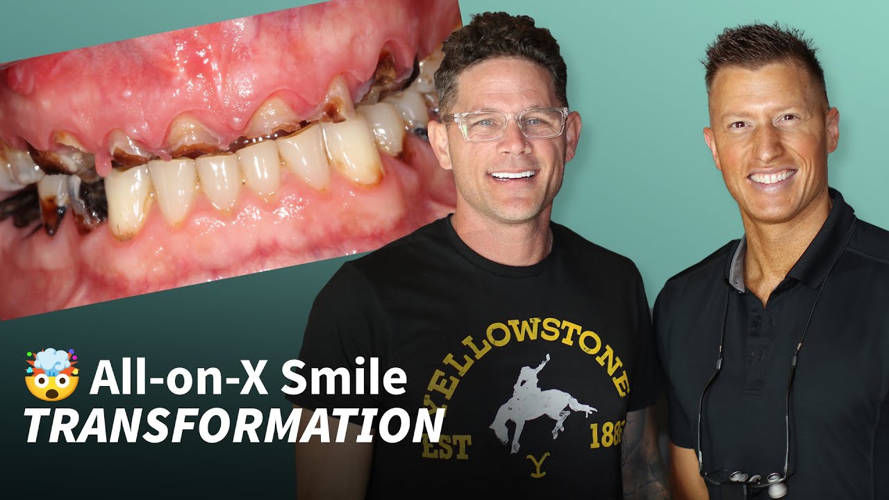 Discover the Life-Changing Power of All on 4 Dental Implants - YouTube