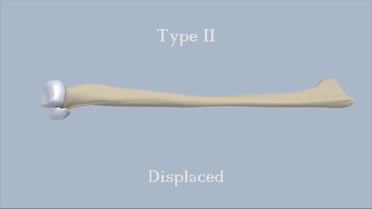 Mason Classification of Radial Head Fractures - YouTube