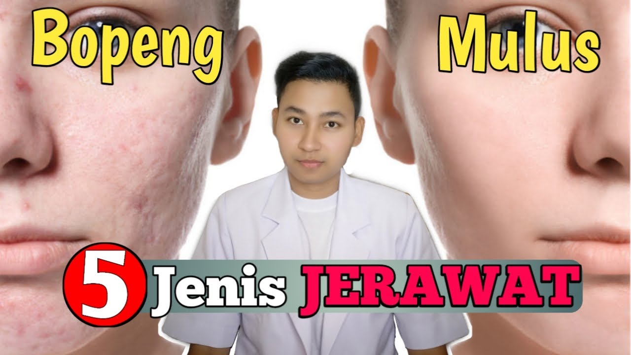 5 Jenis JERAWAT || Penyebab BOPENG di WAJAH - YouTube