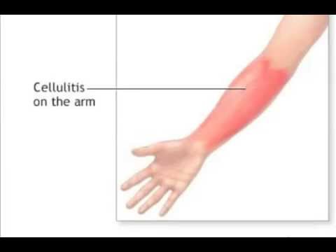 What Is Cellulitis - YouTube