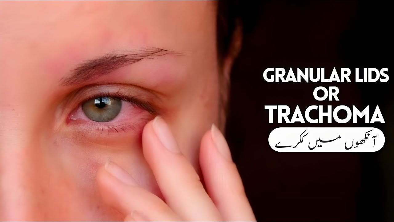 The BEST Treatment of Granular Lids or Trachoma | Homeopathic Medicine ...