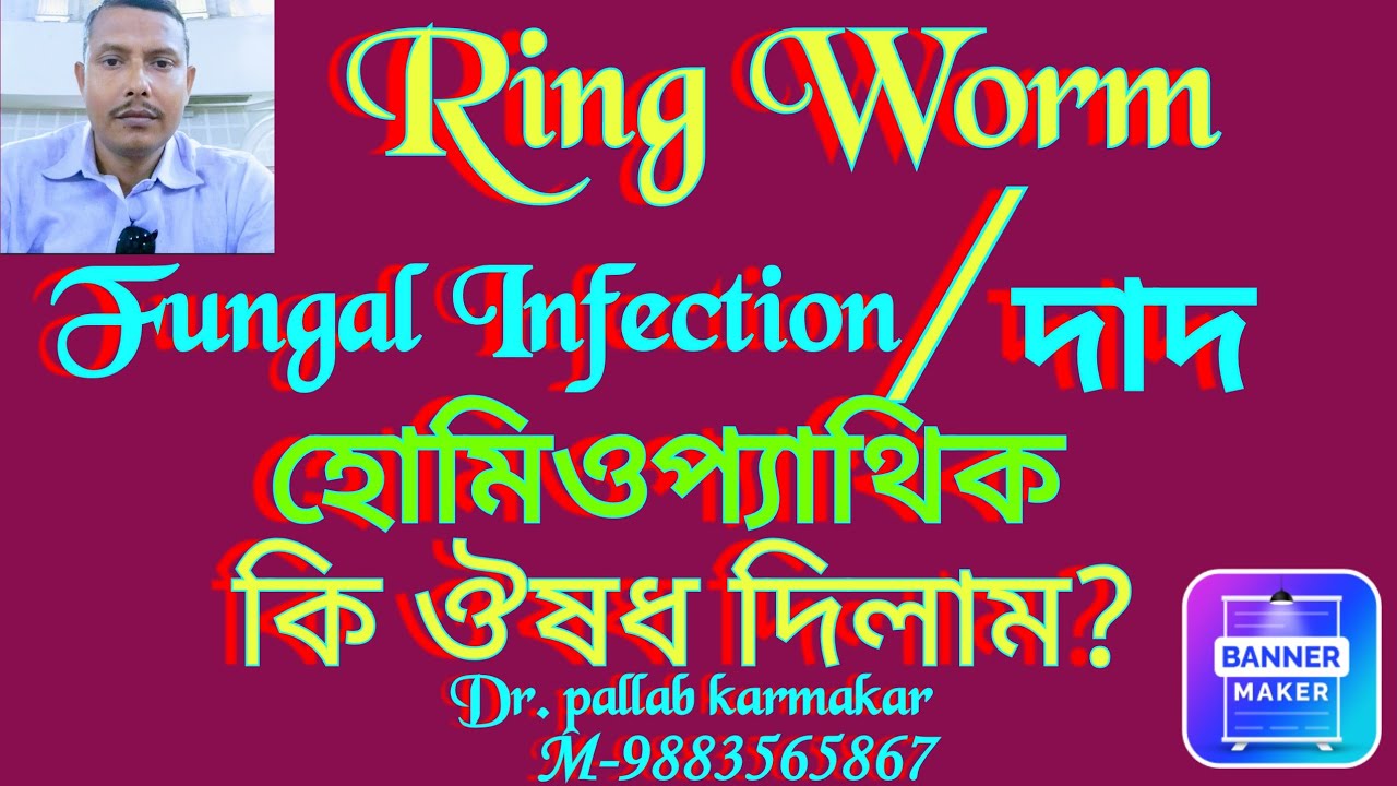 (331)Ring Worm/Fungal Infection /দাদ- কি ঔষধ দিলাম?।। Dr. pallab ...