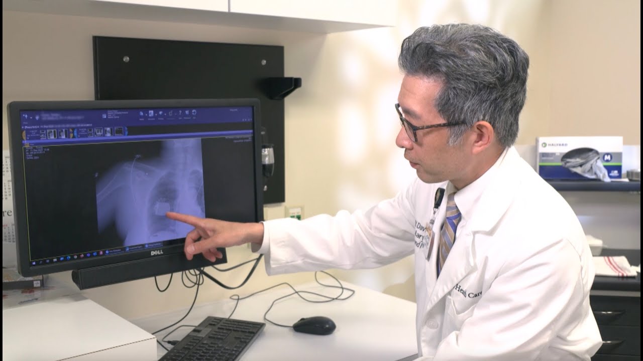 Hypoglossal Nerve Stimulation Device as Novel Treatment for Sleep Apnea ...