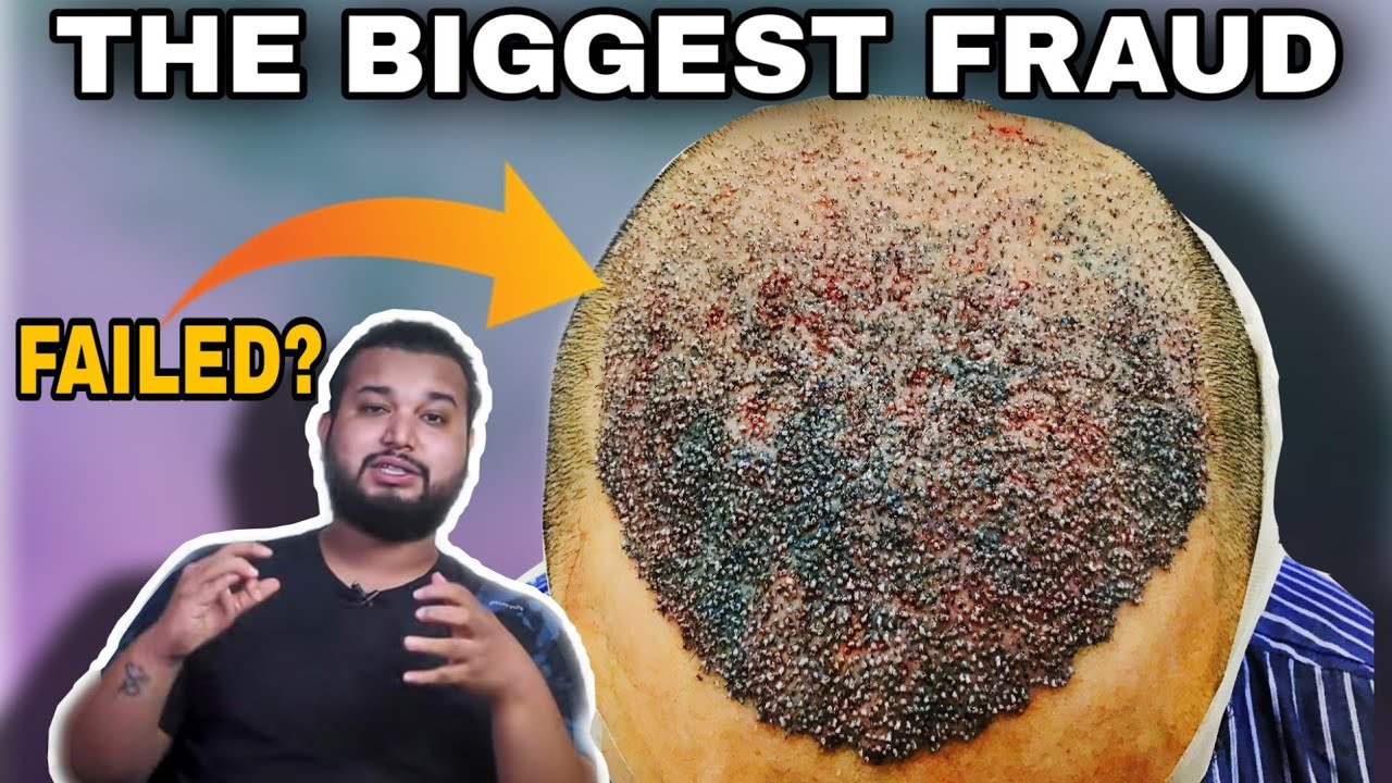 The Biggest Fraud in Hair Transplant || Hair Transplant fail? || Sourav ...