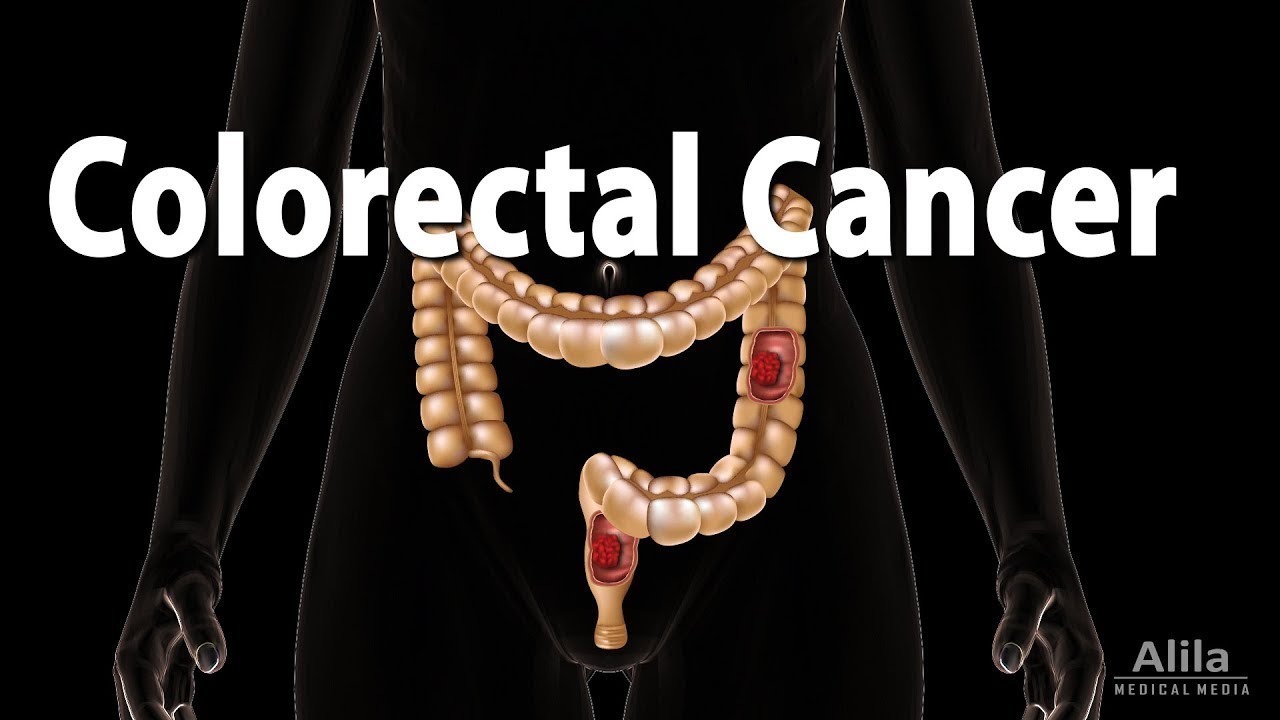 Colon Cancer: Pathology, Symptoms, Screening, Cause and Risk Factors ...