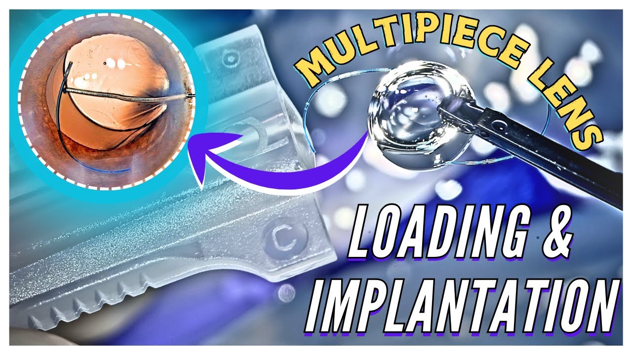 Multi Piece lens loading & implantation - Dr. Deepak Megur - YouTube