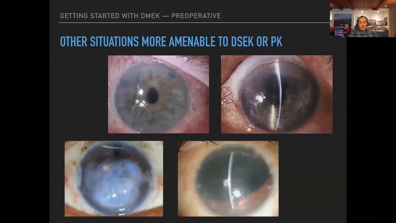 How to Get Started with Descemet Membrane Endothelial Keratoplasty ...