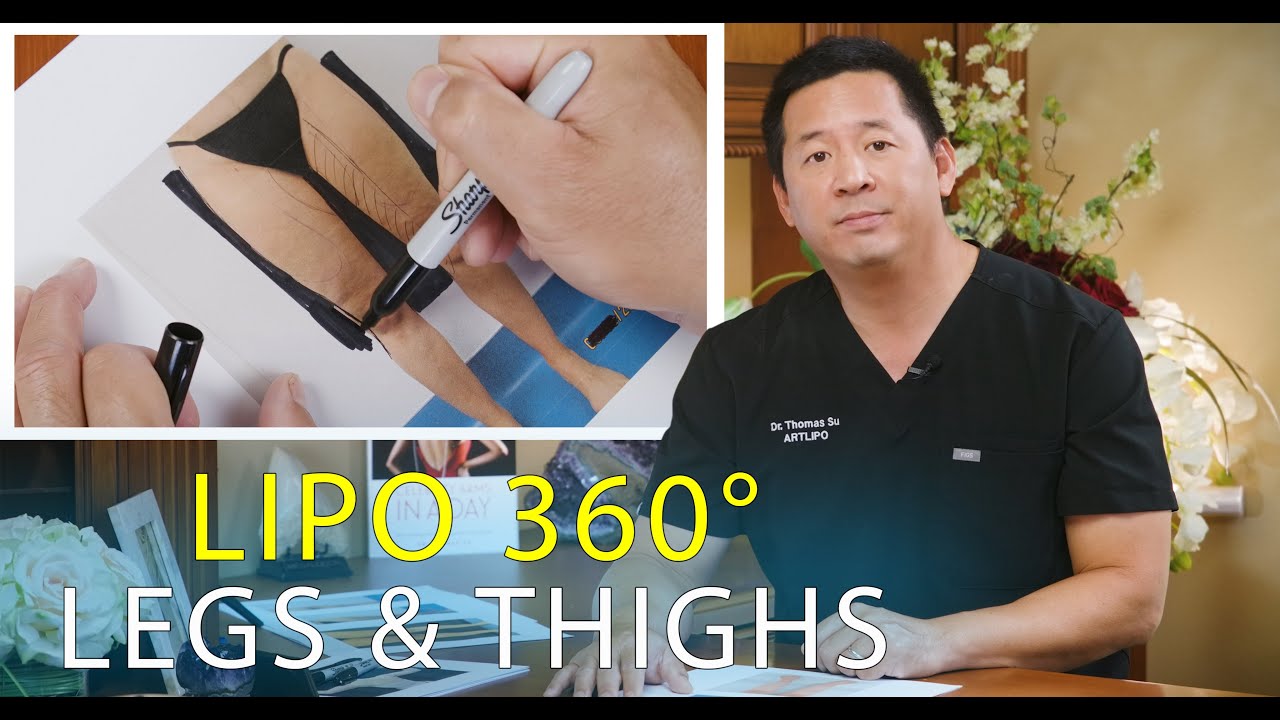 Virtual Consultation | Lipo 360 Thighs | Leg Liposuction | Lipedema Surgery |Artlipo | Expert Dr ...