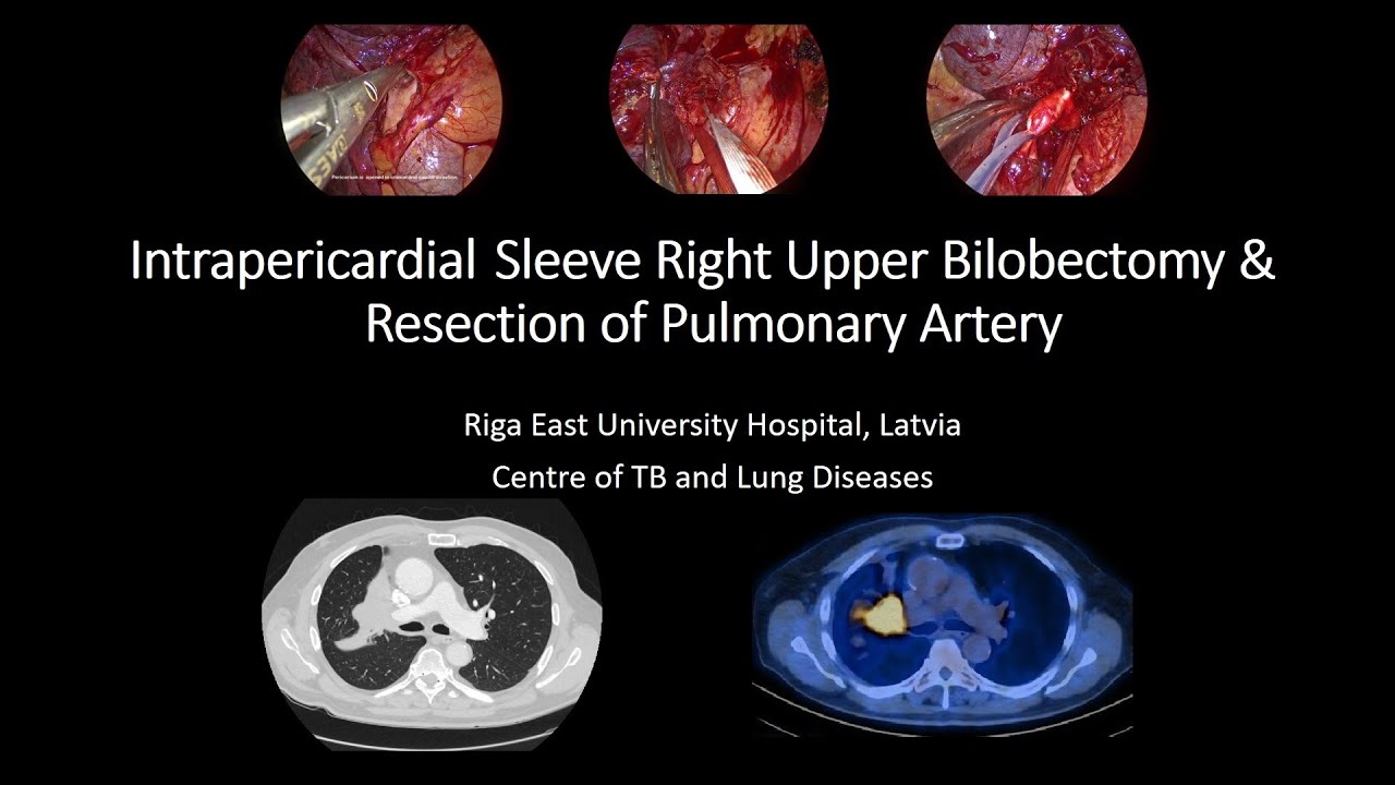 Intrapericardial Sleeve Right Upper Bilobectomy (Vascular Control) and ...
