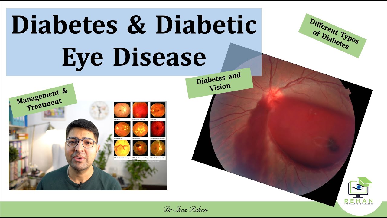 Diabetic Eye Disease (Retinopathy & Maculopathy): Affect on Vision ...