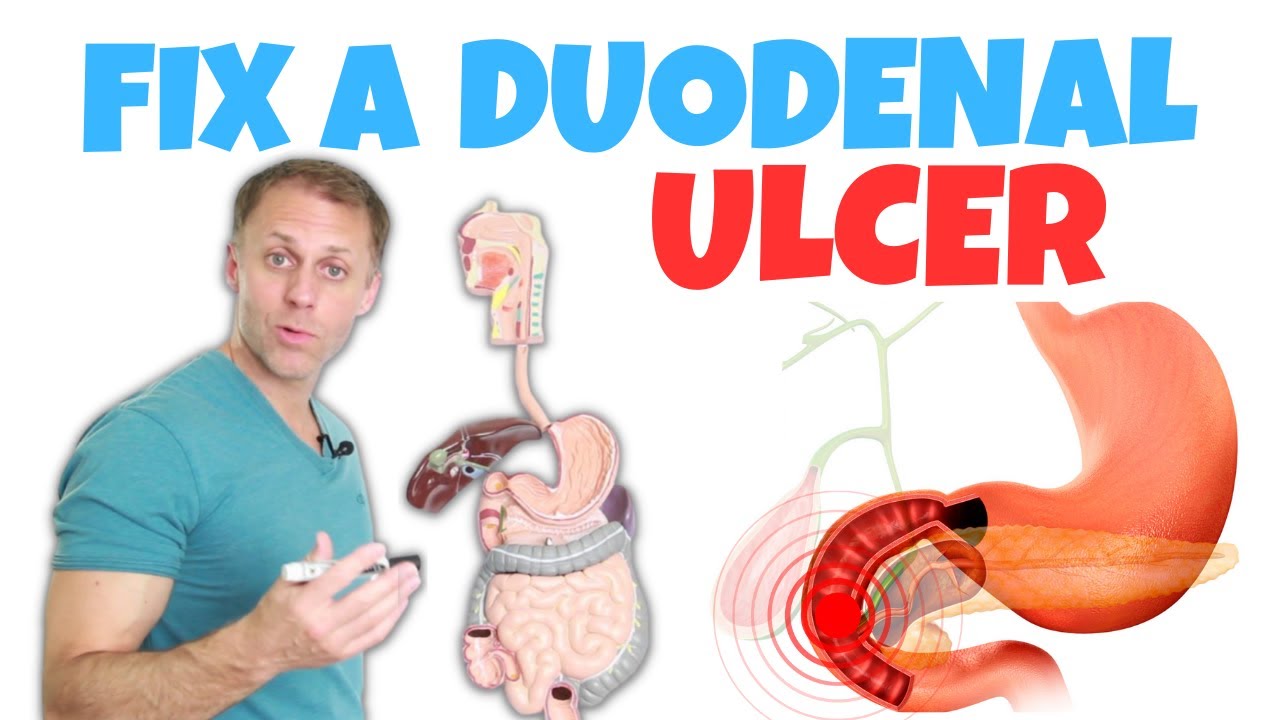 How to Correct a Duodenal Ulcer - YouTube