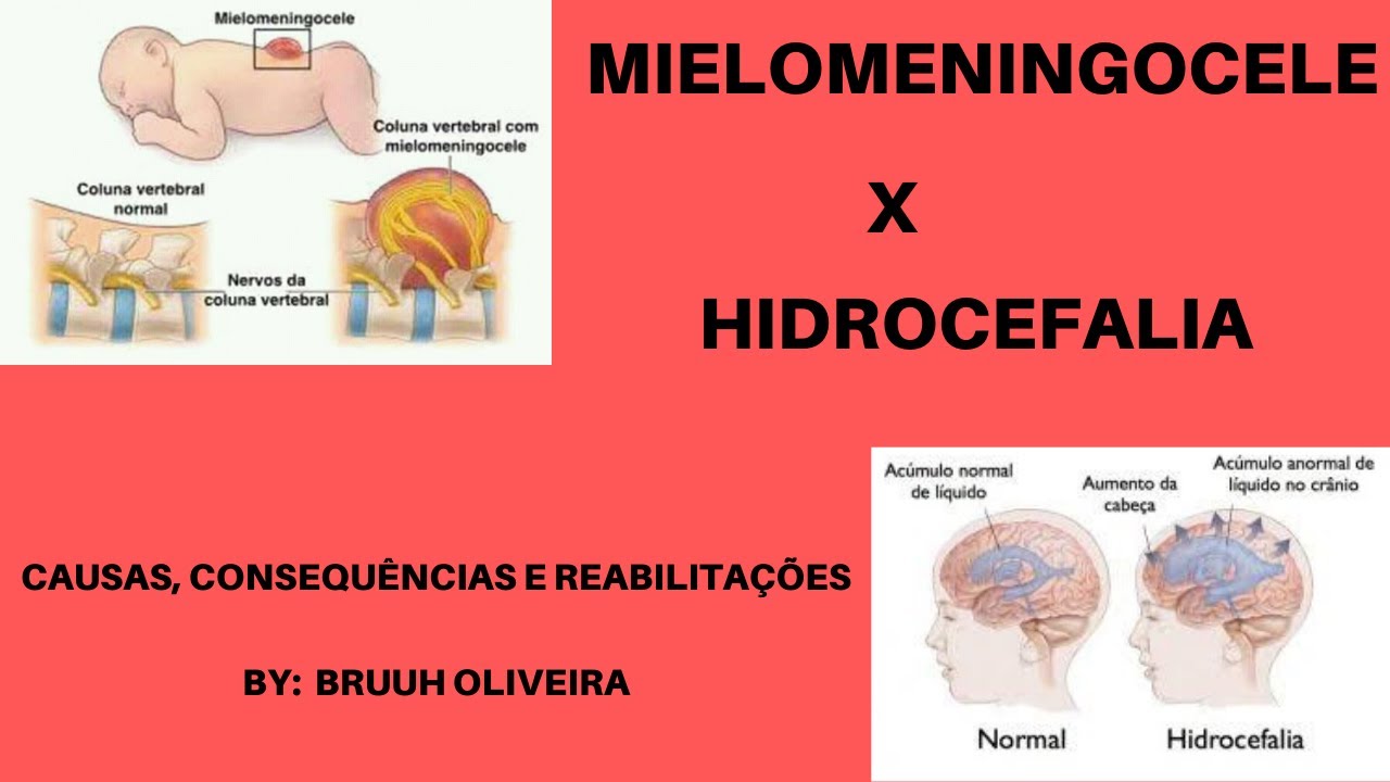 O que é a Mielomeningocele e a Hidrocefalia? Causas, Consequências e ...
