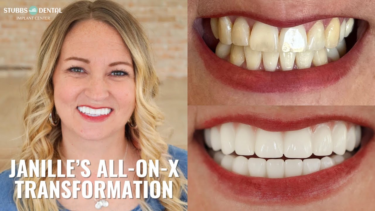 All-on-X Smile Transformation: Janille’s Journey to a Pain-Free Smile ...