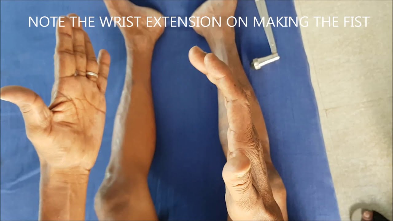 Myelopathic hand - A finding in cervical myelopathy.. - YouTube