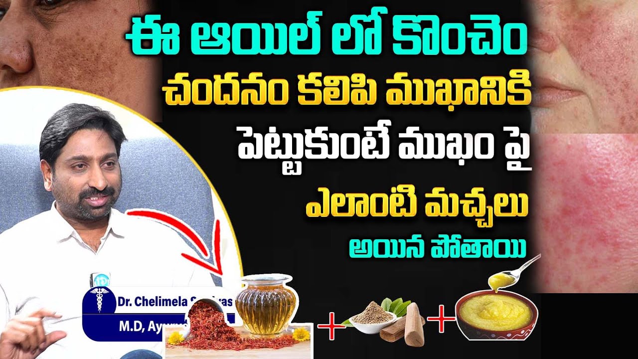What kind of scars on the face will disappear? || Dr Chelimela Srinivas ...