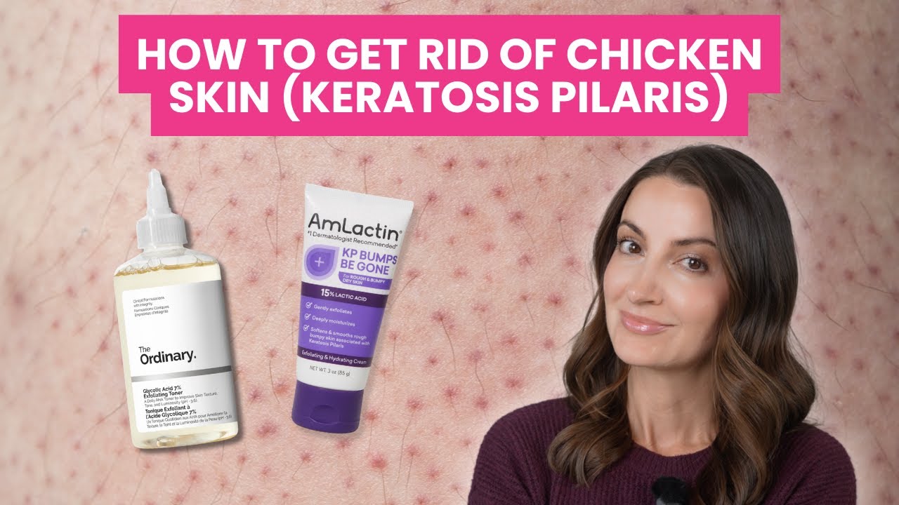 How to Get Rid of Keratosis Pilaris (KP) | Chicken Skin Causes ...