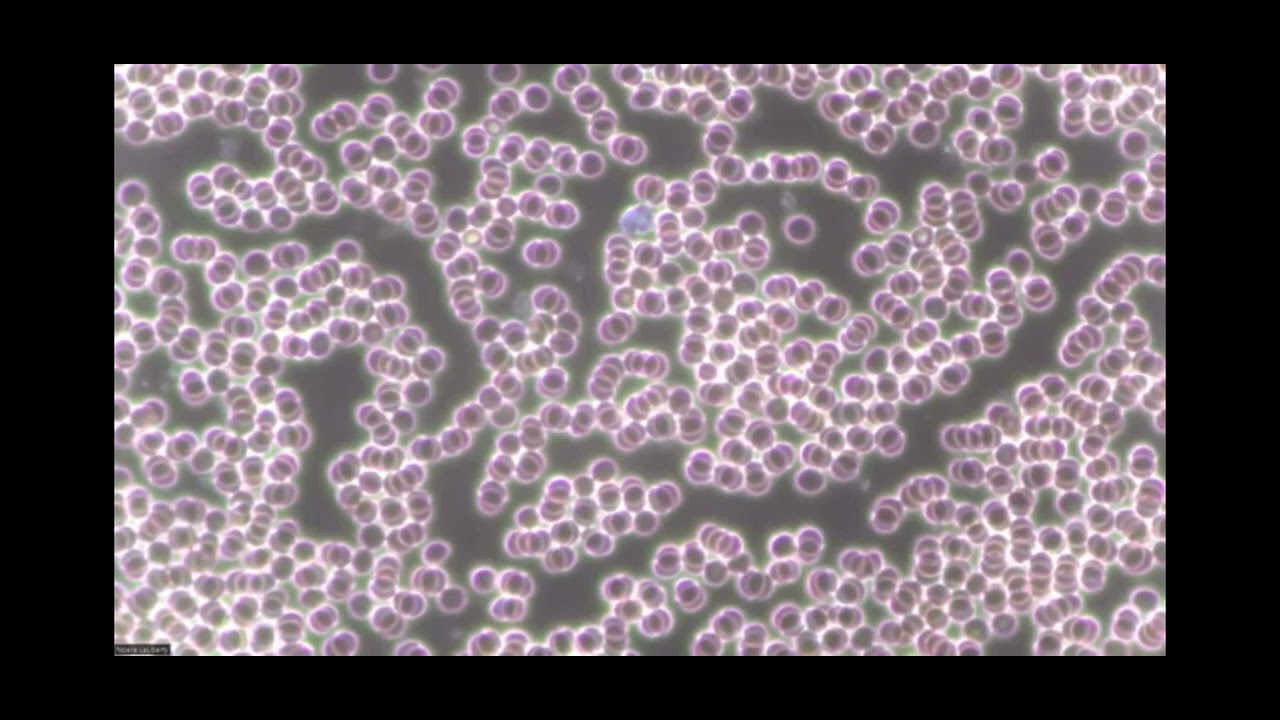 Linda Sereika shares about Live Blood analysis before applying VoxxLife ...