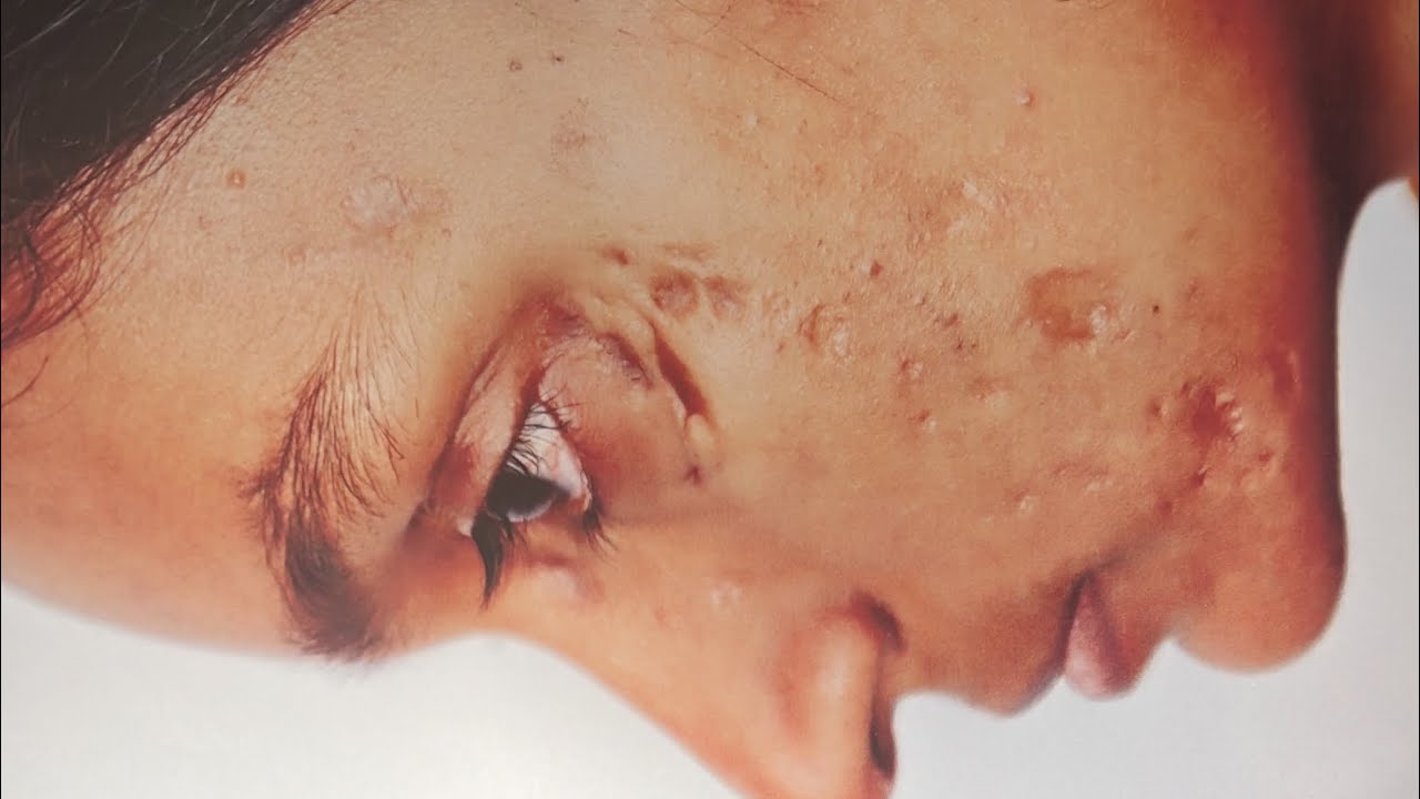 Multiple Scar Revisions done in one go - YouTube