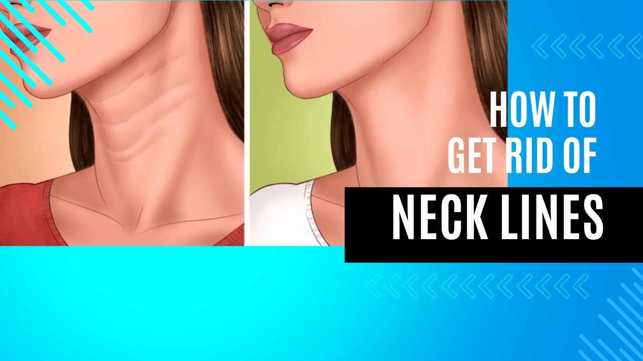 Neck lines / venus neck lines / neck wrinkles - YouTube
