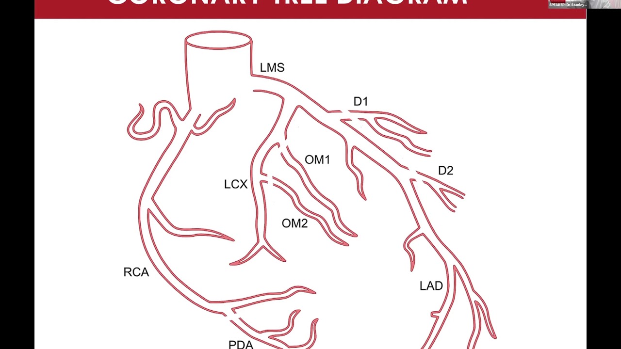 PCI vs CABG Surgery - How do we help our patients to choose? - Dr ...