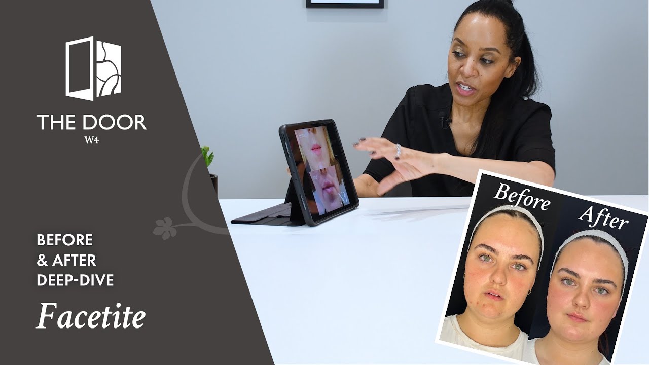 Submental Chin Liposuction & FaceTite Treatment | Before & After | Dr Natasha Berridge | The ...