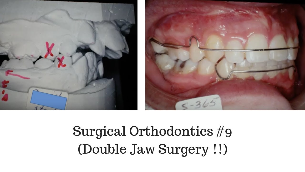 Surgical Orthodontics #9 (Double Jaw Surgery !!) - YouTube