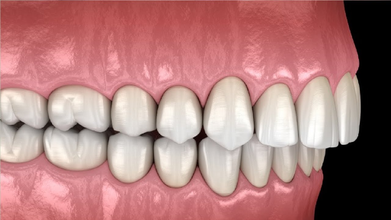 how to fix an overbite with straight teeth - YouTube