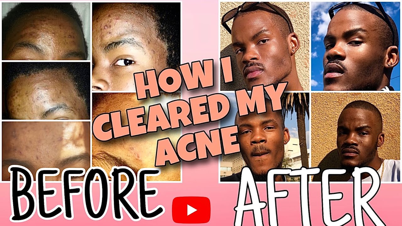 HOW I CLEARED MY ACNE | MY STRUGGLE WITH ACNE AND PIMPLES | SOUTH ...