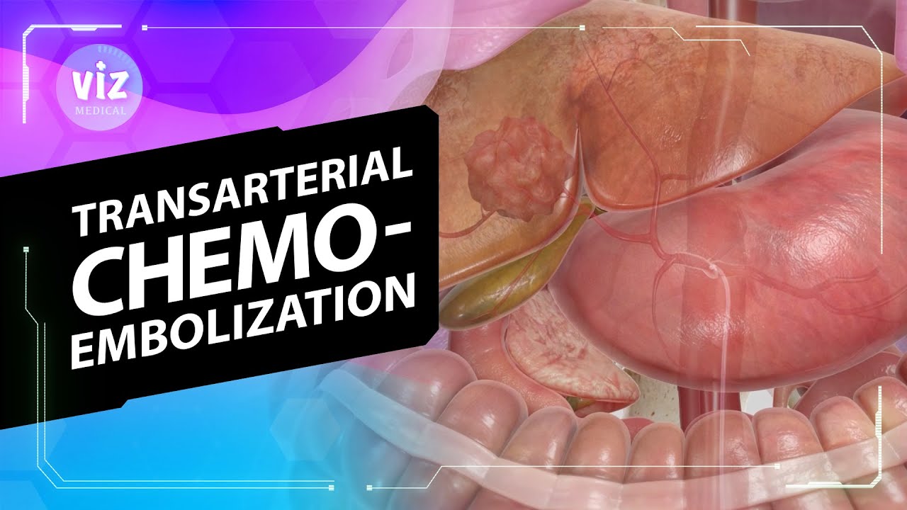 Treating liver cancer through a tiny incision (3D Animation) - YouTube