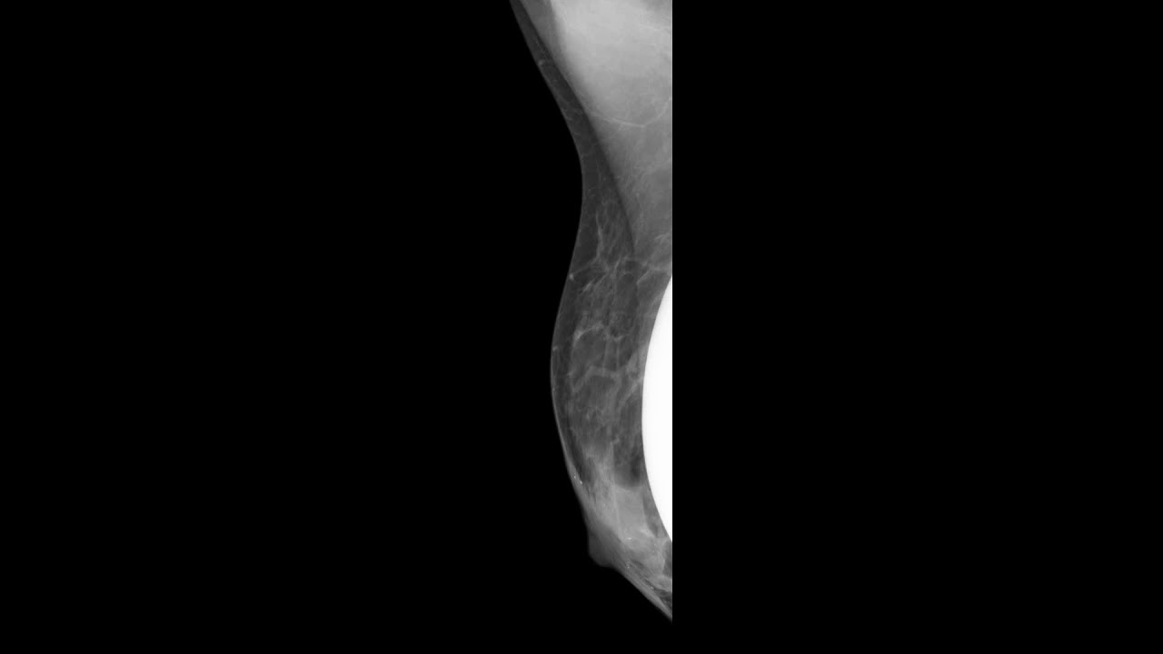 Breast C7 Eklund maneuver (I) - YouTube