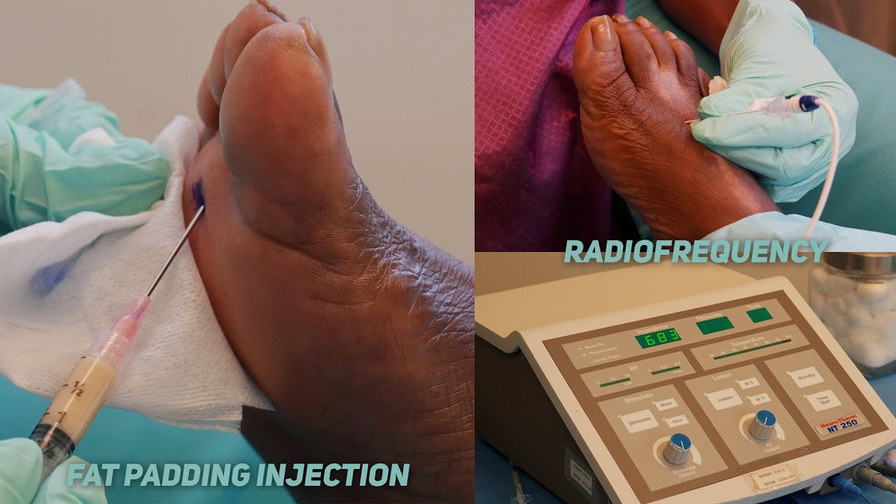 Ablation of a Painful Nerve (Morton's Neuroma) | Radiofrequency and Fat ...