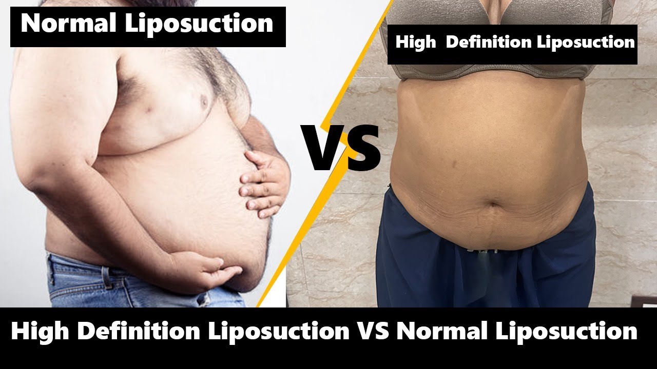 High Definition Liposuction VS Normal Liposuction - YouTube